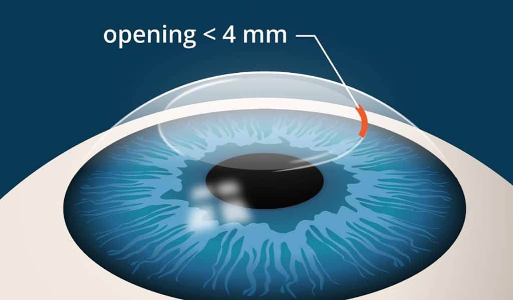 SMILE Laser Eye Surgery - MyVision